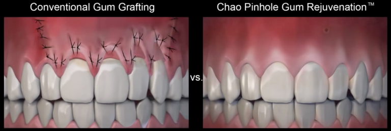 Pinhole Surgical Gum Recession Treatment La Jolla CA